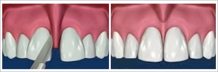 Frenectomy - Phuket Dental Care